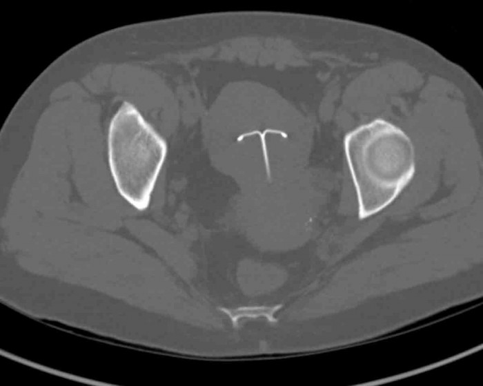 Imagen de DIU - Ginecólogo Dr. Rufino García-Otero Reina | Especialista ...